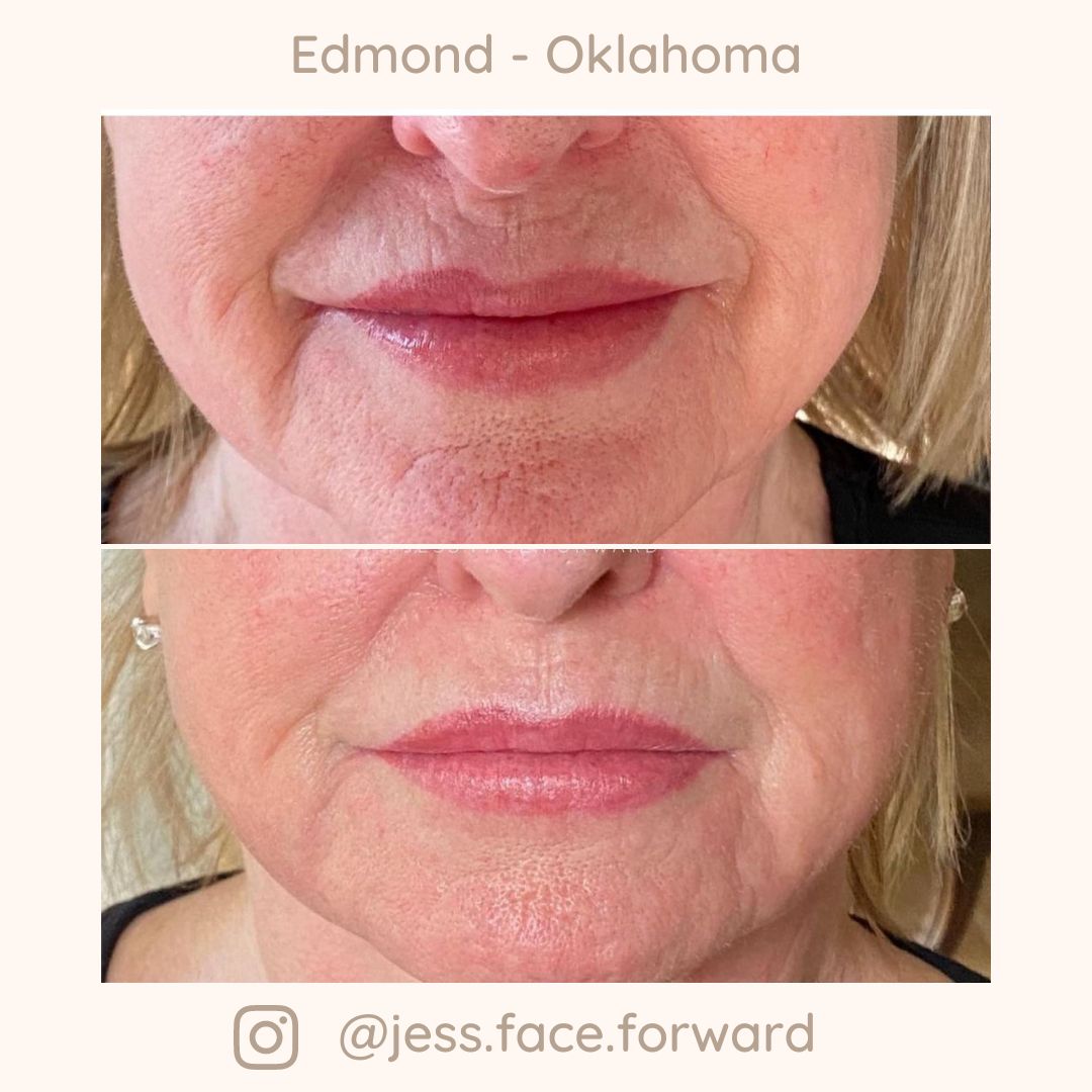 Jet Plasma Live Training - Pro Plasma Esthetic